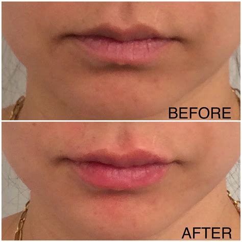 Lip Sync My First Experience With Lip Injection Kangthropologie