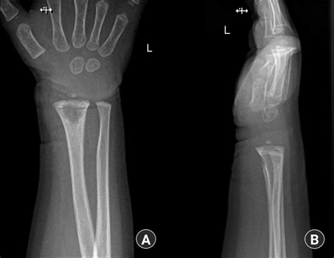 Osteomyelitis X Ray Features