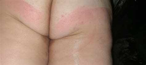 Sun Burn 15 Pics Xhamster