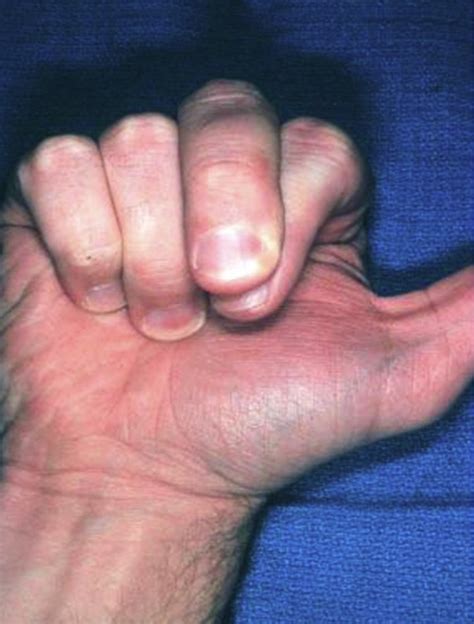 Phalanx Fractures Hand Orthobullets