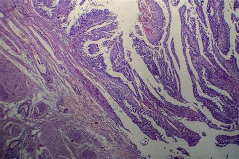 Bladder Transitional Cell Carcinoma Light Micrograph Stock Image Image Of Micrograph Bladder