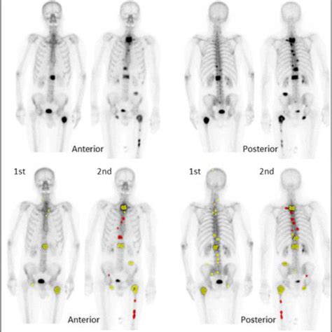 Pdf Progression Of Bone Metastases In Patients With Prostate Cancer Automated Detection Of
