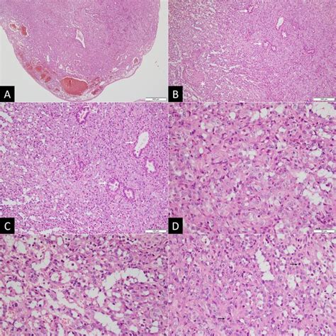 Histopathological Features Tumor Resection Stained For Hematoxylin And Download Scientific