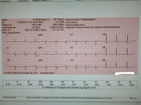Why Is This Not Lm Stemi Rekgs