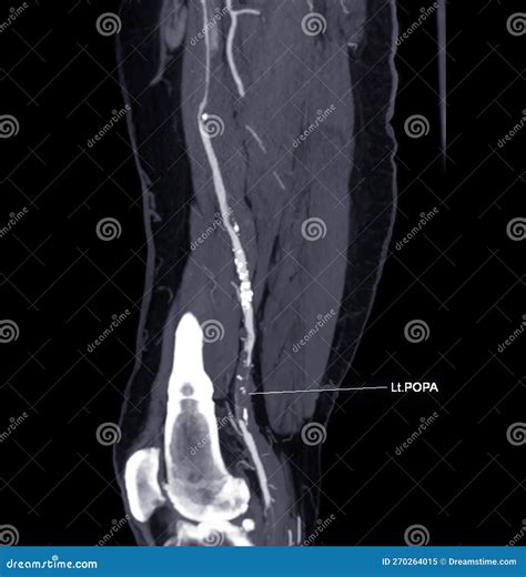 Cta Femoral Artery Run Off Mpr Curve Showing Left Femoral Artery For Diagnostic Acute Or Chronic