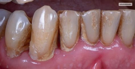 What Does A Cavity Look Like All Signs And Symptoms