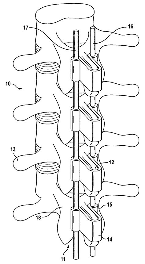Spinal Deformity Patented Technology Retrieval Search Results Eureka Patsnap