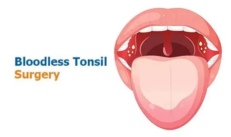 Tonsil Removal Surgery Cost In Vizag Vijayawada And Hyderabad Laser Vs
