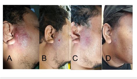 Right Facial Carbuncle Of Case 1 A Right Facial Carbuncle During