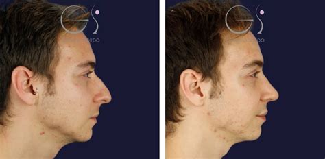 【rhinoplasty Before And After Bulbous Nose 2026】 50 Cases