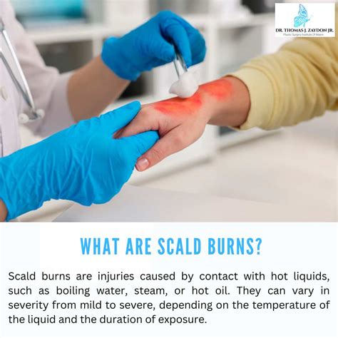 Scald Burns How Temperature And Exposure Time Impact Burn Severity