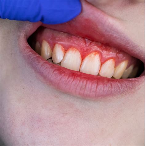 How Can Gum Disease Treatment Improve Your Oral Health Dr Ann Chernyak
