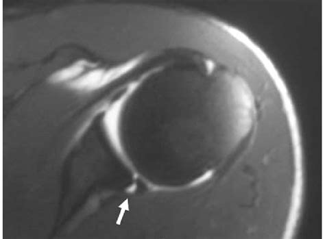Magnetic Resonance Arthrogram Mra Demonstrating Posterior Labral Download Scientific Diagram