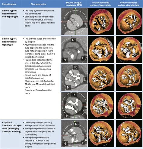 Aortic Valve Stenosis Clinical Tree