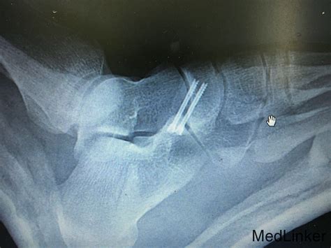 应用bold螺钉内固定融合手术治疗dwightⅡ型足副舟骨临床分析