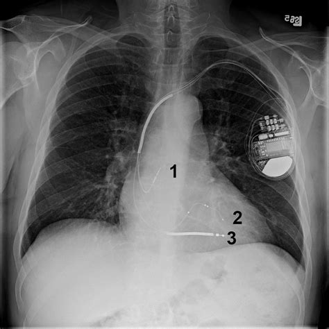 Imagechest X Ray Of A Patient With A Biventricular Bi V Implantable