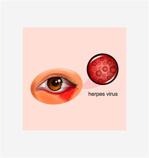 Different Types Of Eye Infections Explained Spectacular By Lenskart