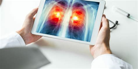 deep learning predicts lung cancer risk from single ct scan rt