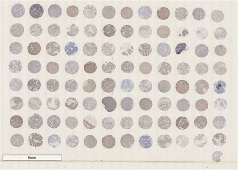 Tumor Microarray 101