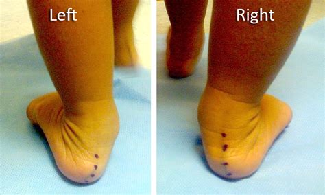 Clinical Diagnosis And Assessment Of The Pediatric Pes Planovalgus