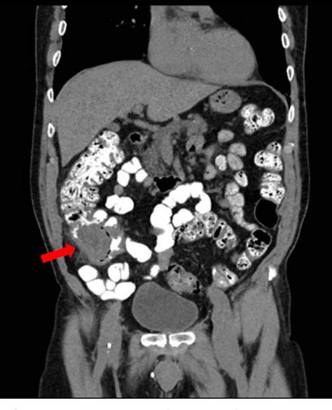 Figure 1 From Colonic Mass After Nsaid Use And Concerns For Malignancy Semantic Scholar