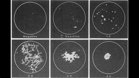 What Is Microscopic Agglutination Test