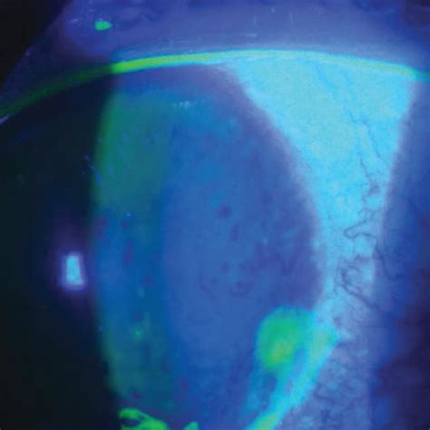 Iritis Versus Episcleritis Versus Scleritis Download Table