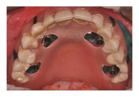 Passive Seating And Occlusal Relationship Of The Removable Prostheses Download Scientific
