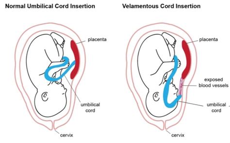 Velamentous Cord Insertion Ultrasound