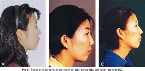 Figure 1 From Cephalometric Evaluation Of The Anterior Open Bite Treatment Semantic Scholar