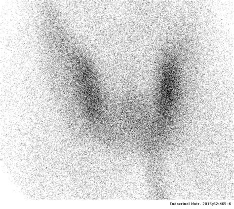 Hyperthyroidism Induced By Topical Iodine Endocrinología Y Nutrición