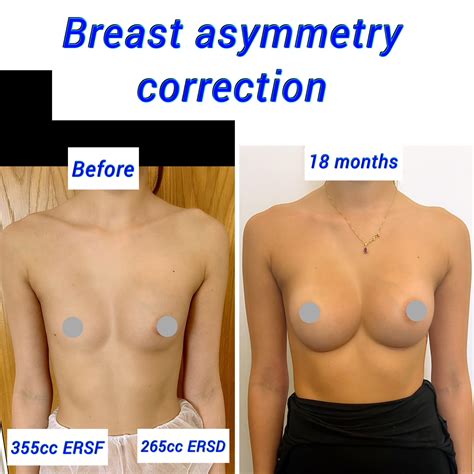 Uneven Breasts Surgery Before And After Breast Implants Before And