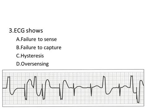 Pacemaker Troubleshooting Single Chamber Pacemakers Ppt Video Online