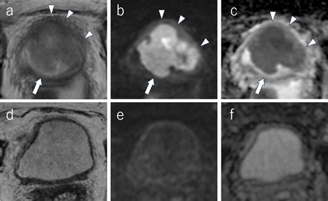 Multiparametric Mri And Artificial Intelligence In Predicting And