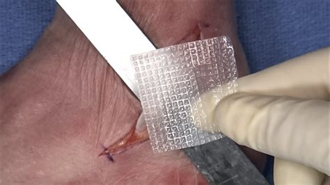 Peroneal Tendon Surgery The 5 Recovery Stages You Must Know