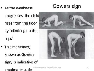 Gowers Sign