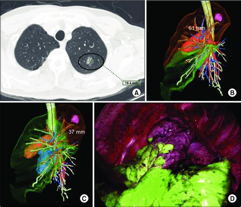 A Axial View Chest Computed Tomography 17 Mm Part Solid Ground Glass Download Scientific