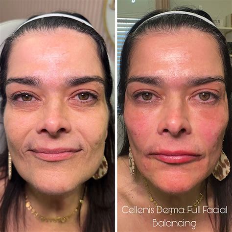 Cellenis Derma Prp Brandon Fl Balance Aesthetic And Wellness