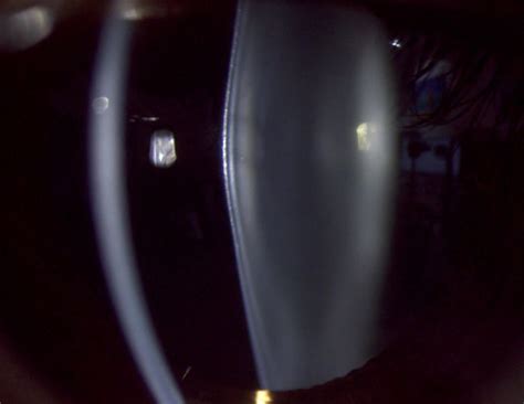 Filelenticonus Eyewiki