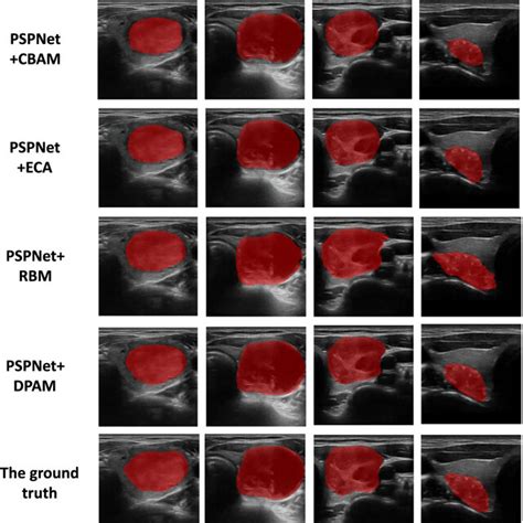 Results Of Ablation Experiment Segmentation The A And B Are Benign Download Scientific