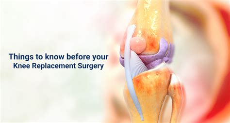Things To Know Before Your Knee Replacement Surgery Eternal Hospital