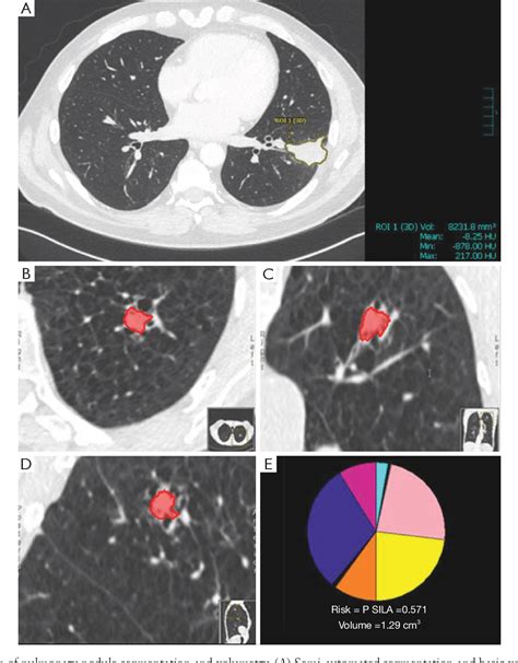 Figure 2 From Implications Of The Updated Lung Ct Screening Reporting
