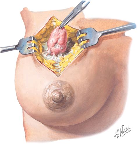 Breast Biopsy Open Clinical Tree