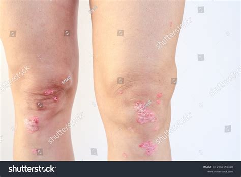 172 Knee Effusion Gambar Foto Stok And Vektor Shutterstock