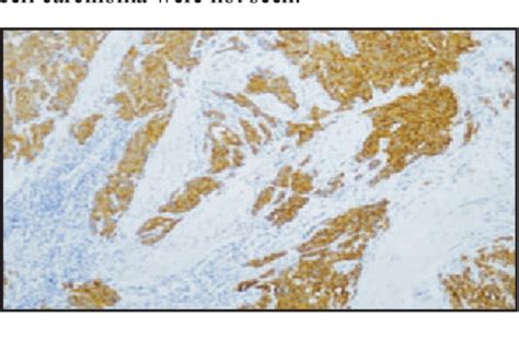 Figure 3 From Ectopic Cushings Syndrome From Prostatic Adenocarcinoma