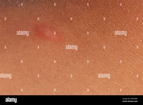 Insect Bite Close Up On The Skin Allergic Reaction Diseases And
