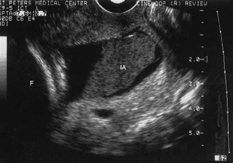 Placental Abruption Ultrasound Diagnosis