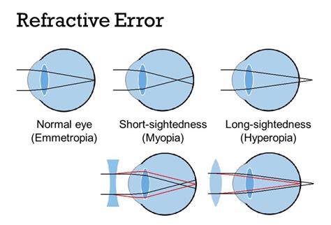 Refractive Errors