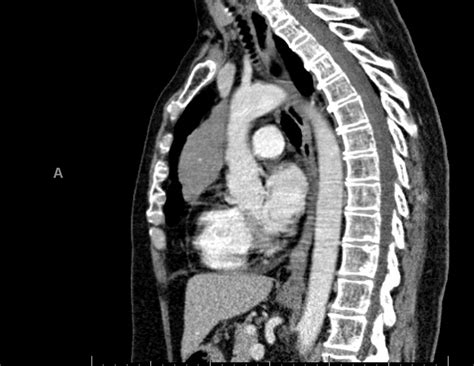 Ct Chest Sagittal Of Patients Original Ct Chest Scan Download