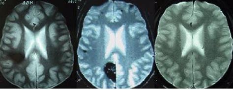 Mris Of Ccms The Echo Gradient Sequences Of The Proband Left Download Scientific Diagram